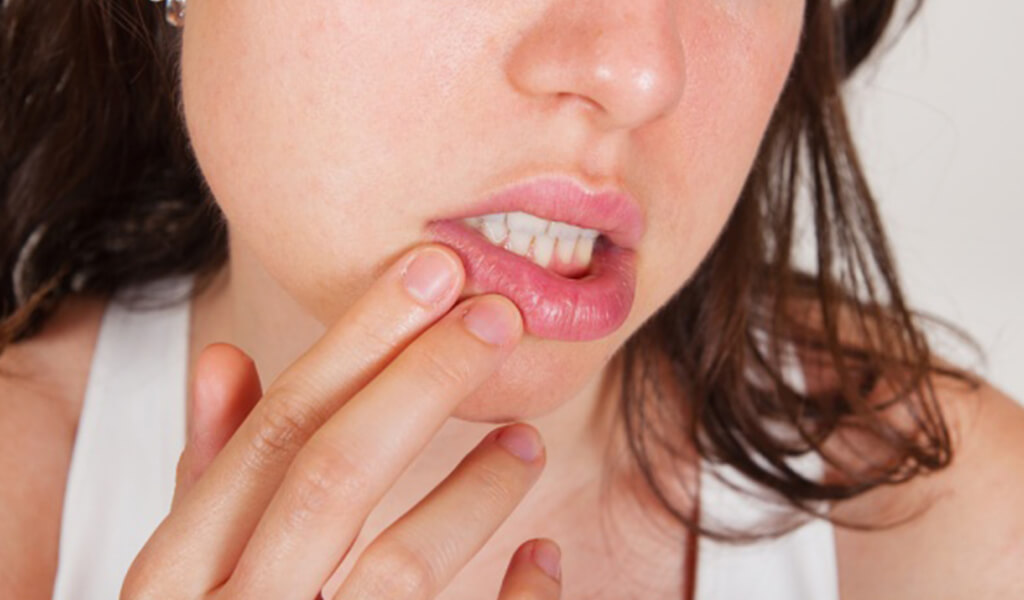 Waspada Jika Anda Sering Sariawan - RS Delima Asih Sisma Medika